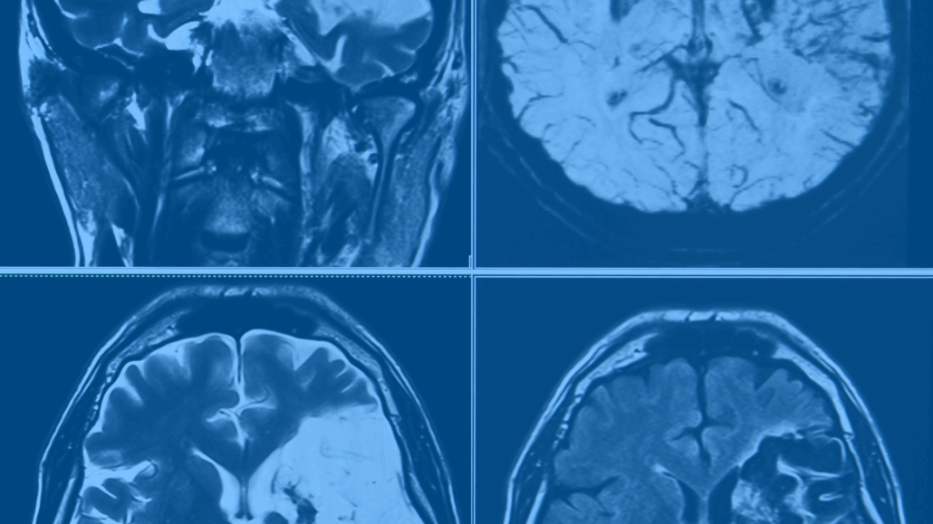 Performance of Aidoc’s VO Algorithm vs. Conventional AI